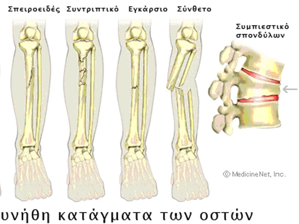 Οσφυική μοίρα αθλητών - Onsports.gr