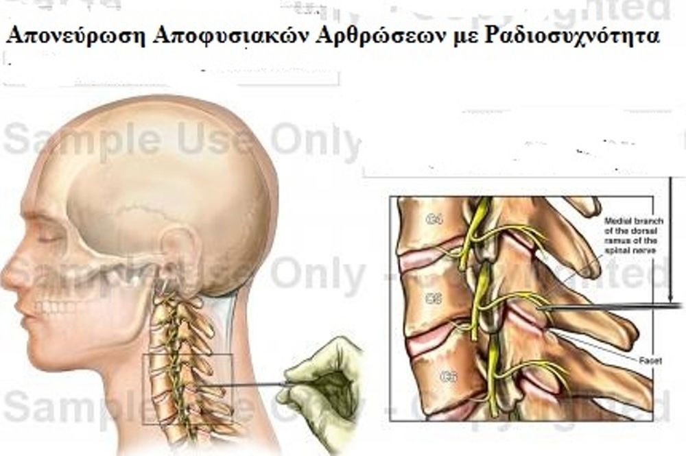 Σύνδρομο Ζυγοαποφυσιακών Αρθρώσεων Αυχένα - Onsports.gr